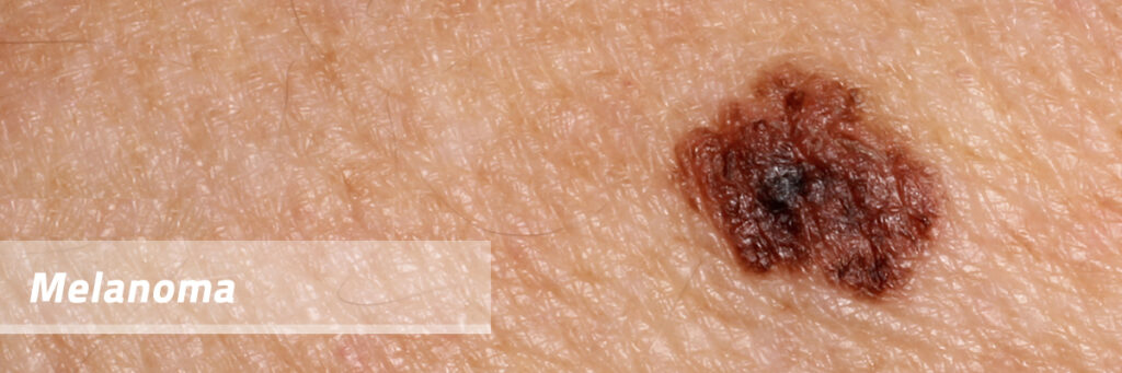 Types of Skin Cancer - Dermatology Center of Canyon County